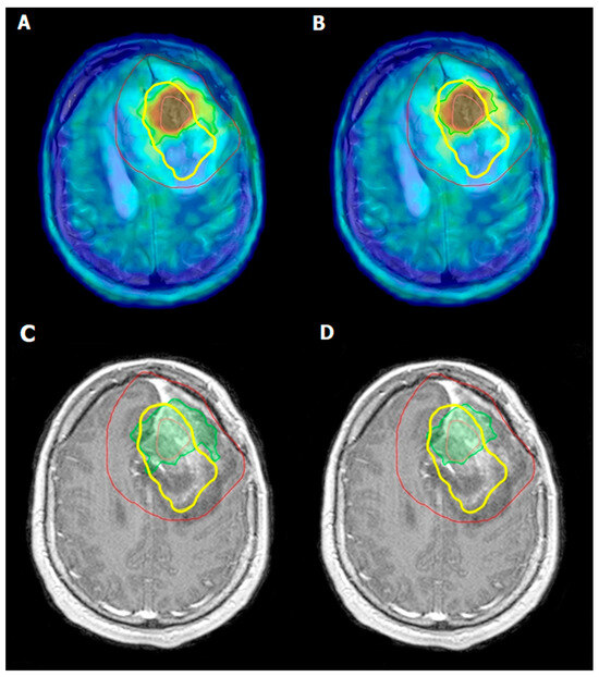 Complex Diagnostic Challenges in Glioblastoma: The Role of 18F-FDOPA ...