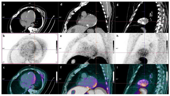 Gallium-Labeled PET Radiopharmaceuticals in Cardiovascular Disease