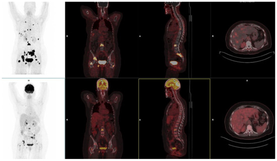 Fibroblast Activation Protein Inhibitor (FAPI)-Based Theranostics