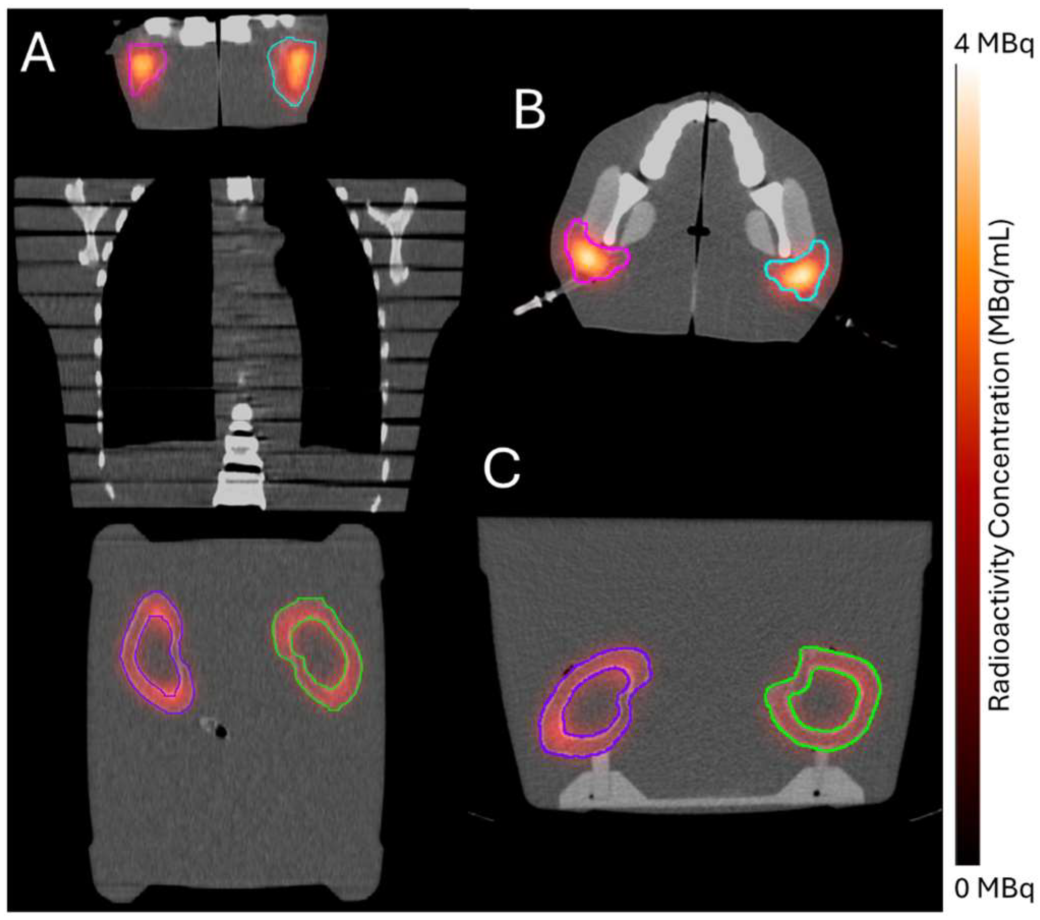3D-Printed Organ-Realistic Phantoms to Verify Quantitative SPECT/CT Accuracy for 177Lu-PSMA-617 ...
