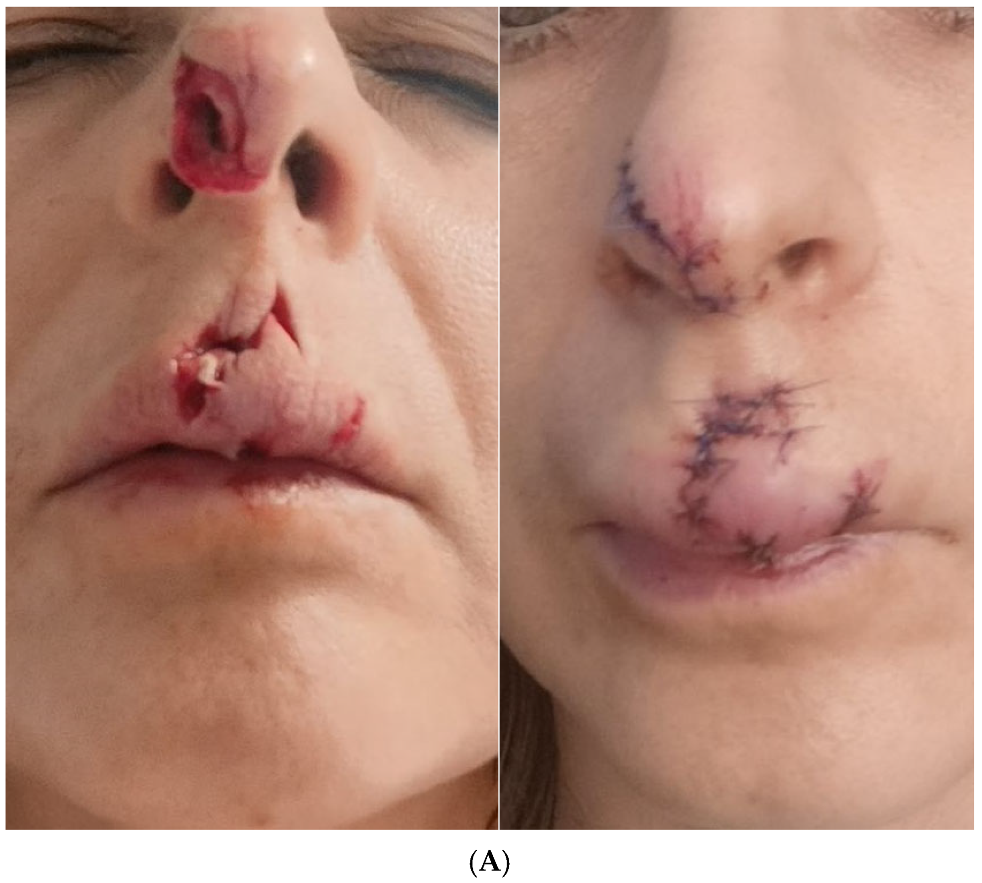 Therapeutic Efficacy of Plant-Derived Exosomes for Advanced Scar ...