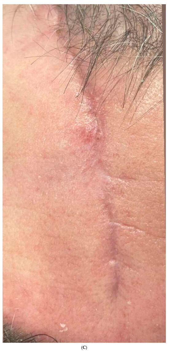 Therapeutic Efficacy of Plant-Derived Exosomes for Advanced Scar ...