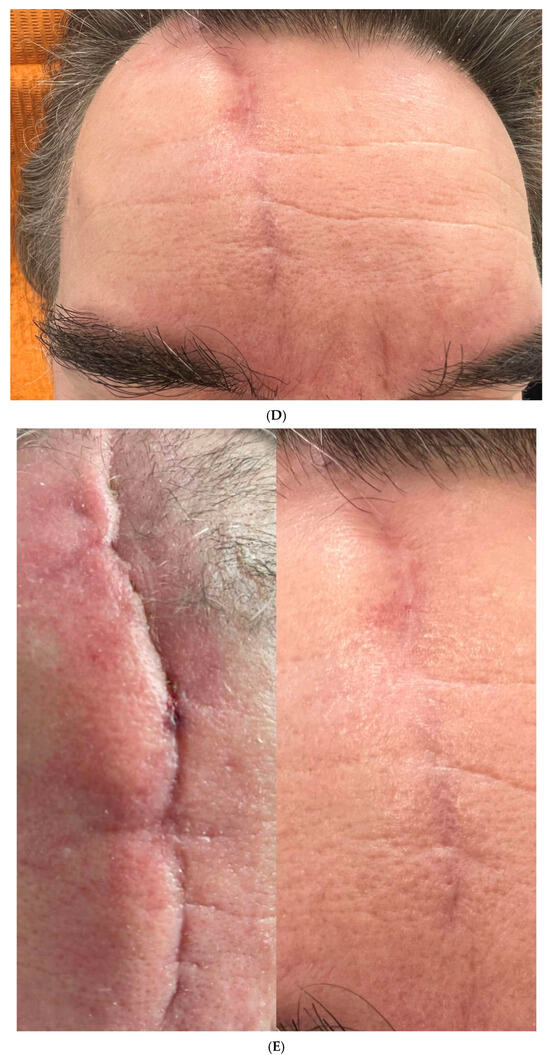 Therapeutic Efficacy of Plant-Derived Exosomes for Advanced Scar ...