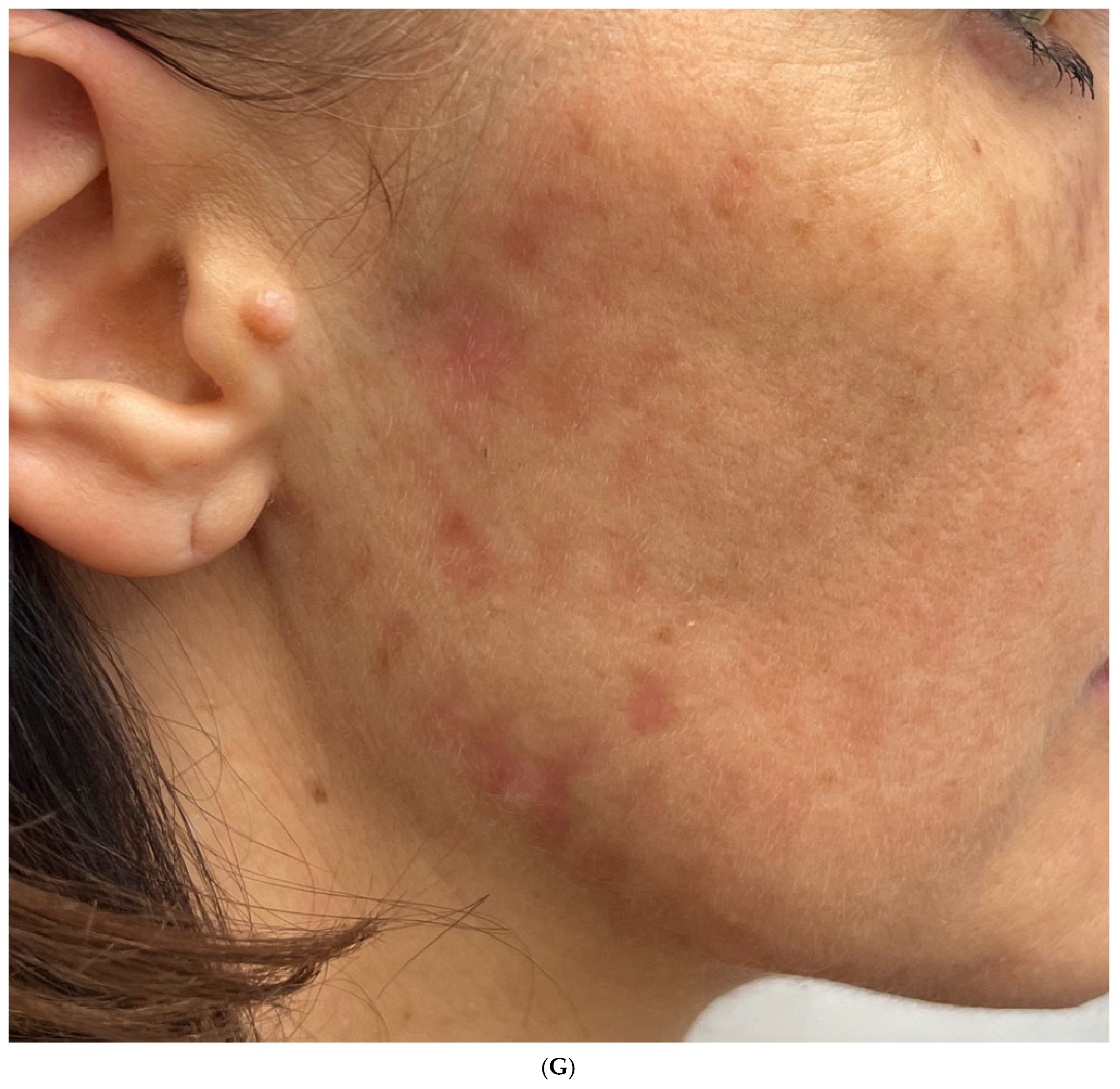 Therapeutic Efficacy of Plant-Derived Exosomes for Advanced Scar ...