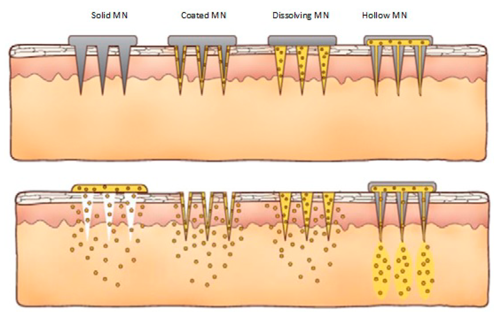 Pharmaceutics | Free Full-Text | Transdermal Delivery of Drugs with ...