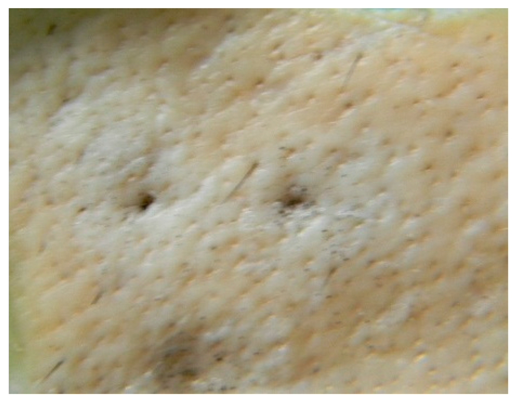 Pharmaceutics | Special Issue : Microneedle Patches: Developing ...