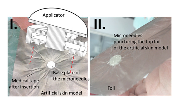 Pharmaceutics | Special Issue : Microneedle Patches: Developing ...