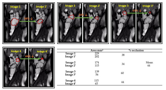 Dynamic Colon Model (DCM): A Cine-MRI Informed Biorelevant In Vitro ...