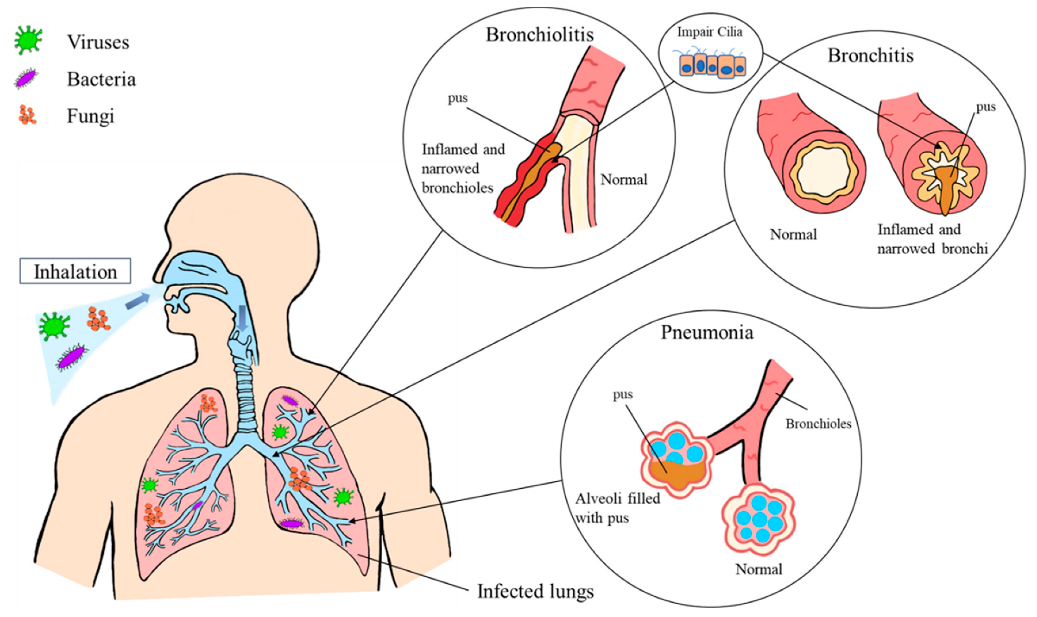 A Critical Review on Emerging Trends in Dry Powder Inhaler Formulation ...