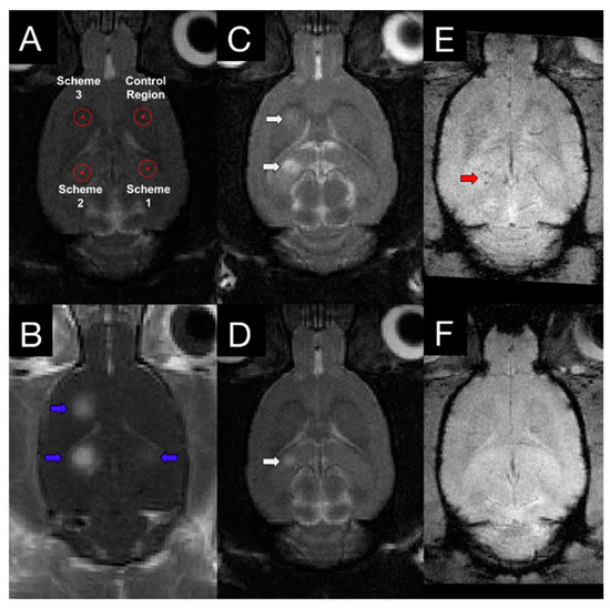 Focused Ultrasound and Microbubbles-Mediated Drug Delivery to Brain Tumor