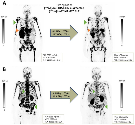 Efficacy and Safety of [225Ac]Ac-PSMA-617 Augmented [177Lu]Lu-PSMA-617 ...