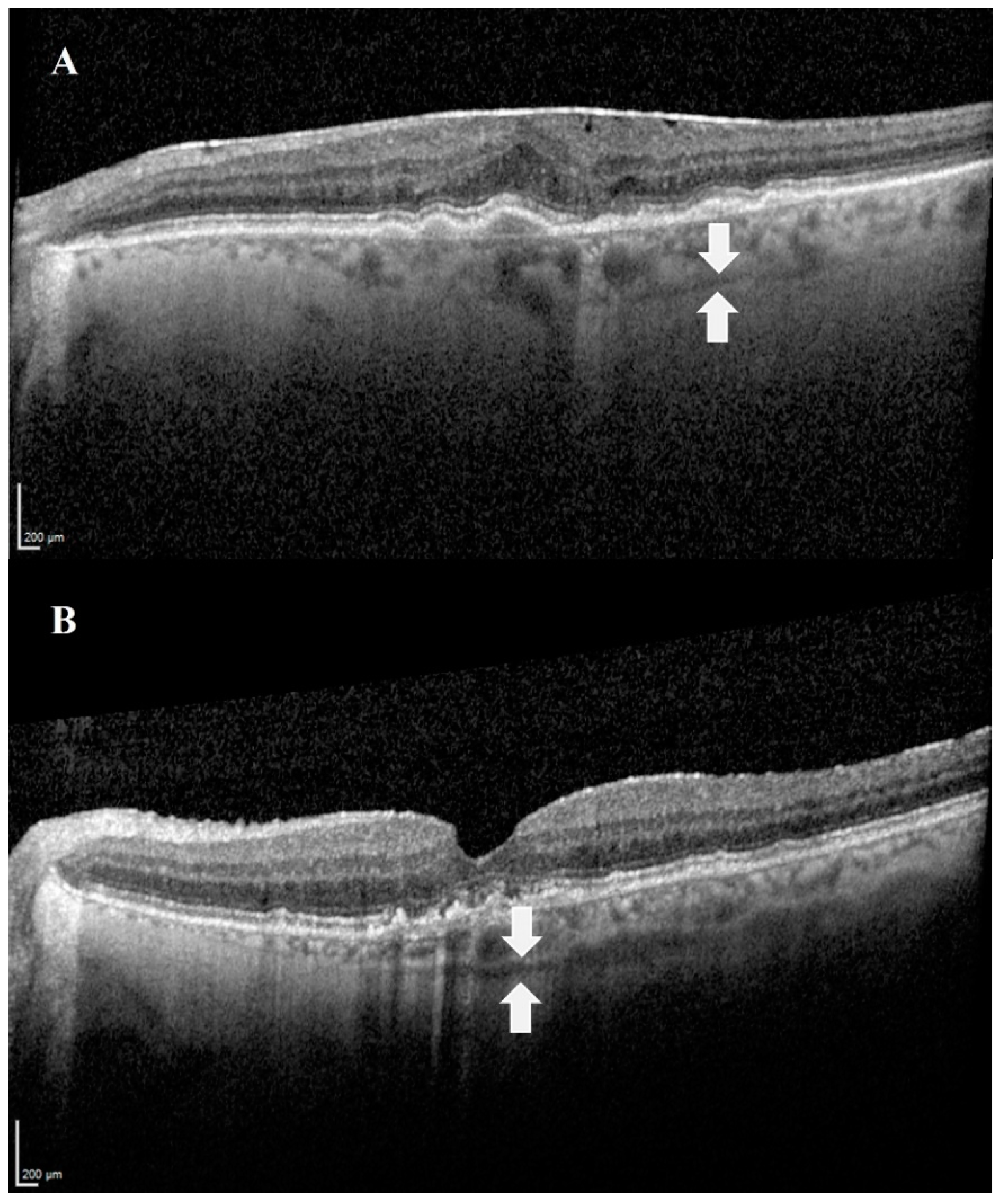 Drug Delivery via the Suprachoroidal Space for the Treatment of Retinal ...
