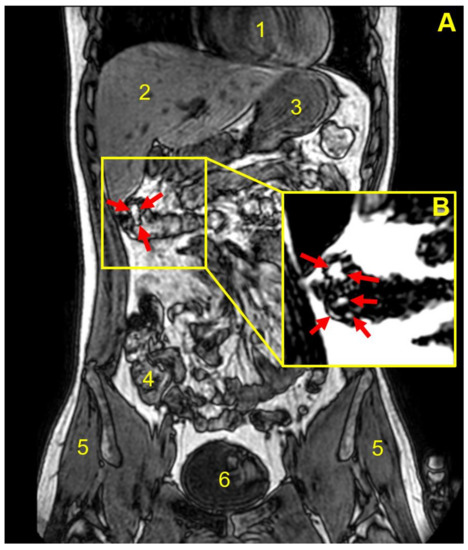 Application of In Vivo MRI Imaging to Track a Coated Capsule and Its ...