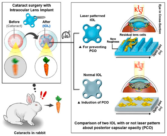 Research Progress Concerning a Novel Intraocular Lens for the ...