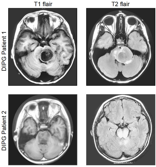 Immunogenic Cell Death Enhances Immunotherapy of Diffuse Intrinsic Pontine Glioma: From ...