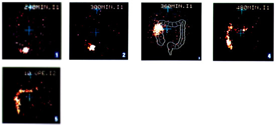 Time-Based Formulation Strategies for Colon Drug Delivery