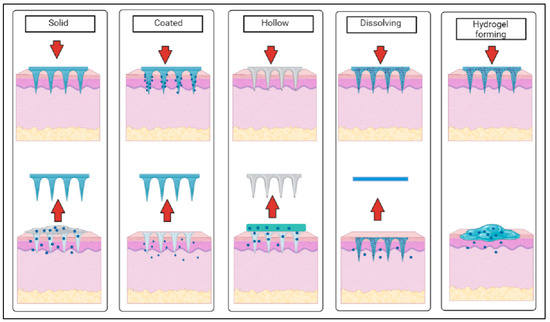 Microneedles for Efficient and Precise Drug Delivery in Cancer Therapy