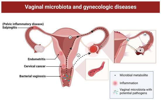 Potential Role of Vaginal Microbiota in Ovarian Cancer Carcinogenesis, Progression and Treatment