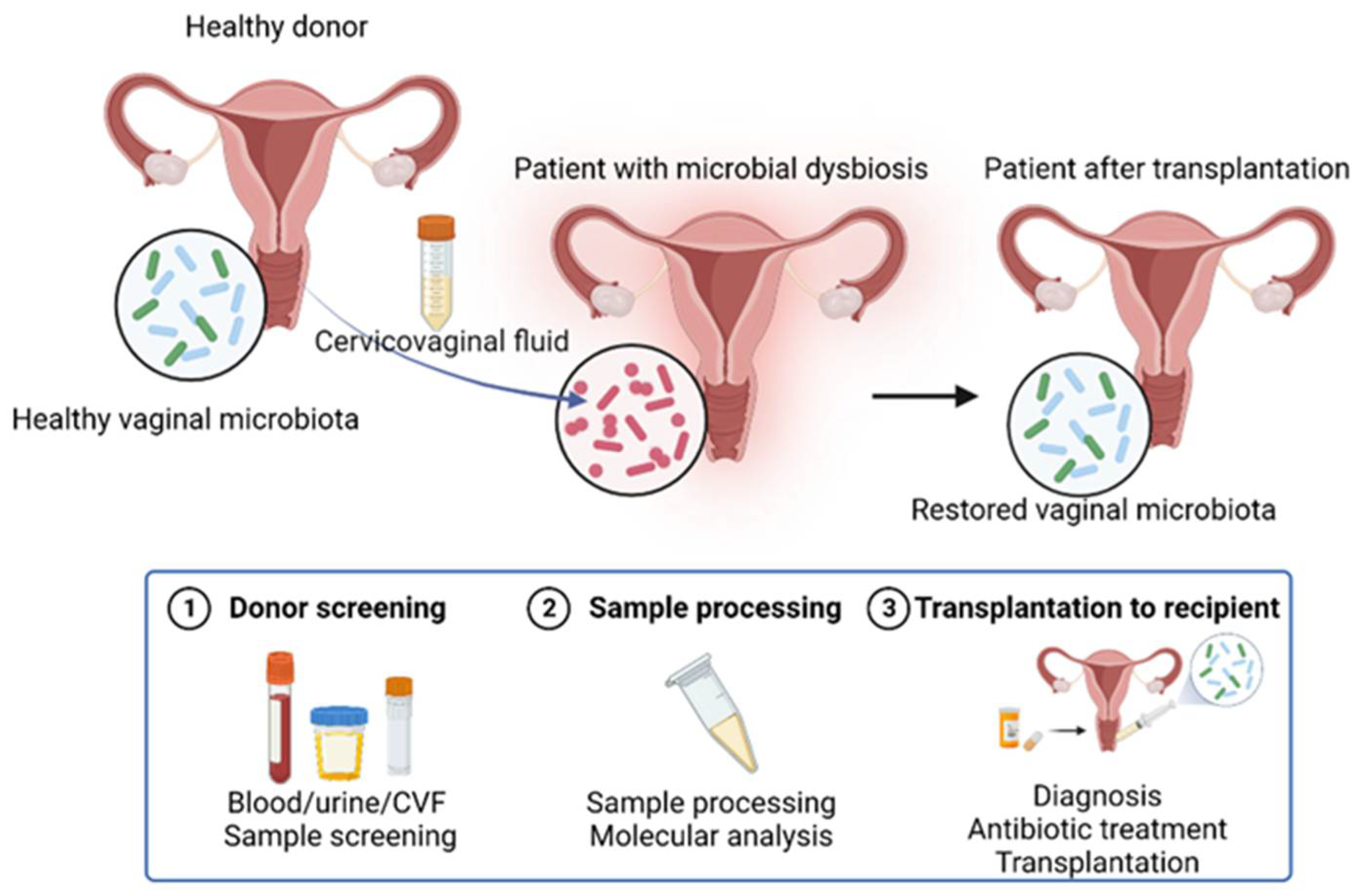 Potential Role of Vaginal Microbiota in Ovarian Cancer Carcinogenesis, Progression and Treatment