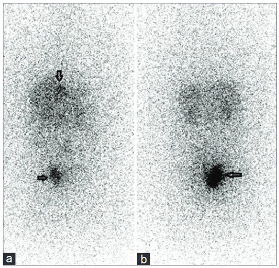 225Ac-Labeled Somatostatin Analogs in the Management of Neuroendocrine ...