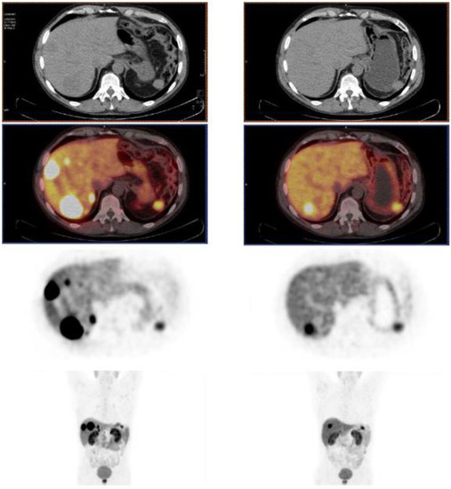 225Ac-Labeled Somatostatin Analogs in the Management of Neuroendocrine ...