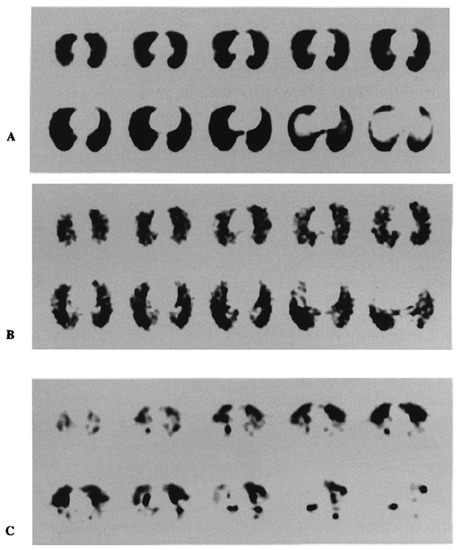 Technegas, A Universal Technique for Lung Imaging in Nuclear Medicine ...