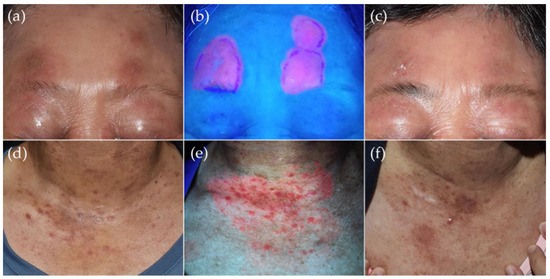 Cutaneous T Cell Lymphoma Face