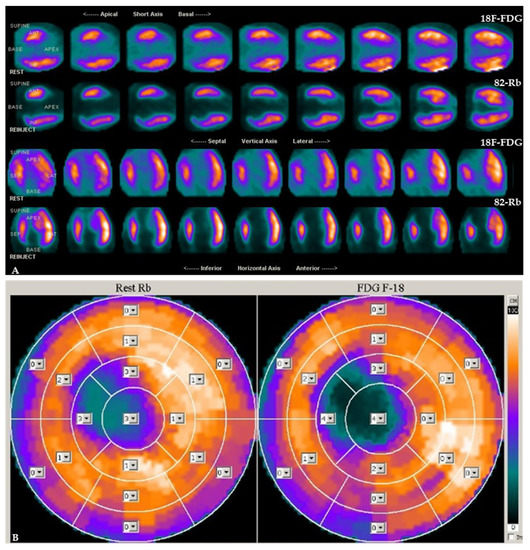 Tracers for Cardiac Imaging: Targeting the Future of Viable Myocardium