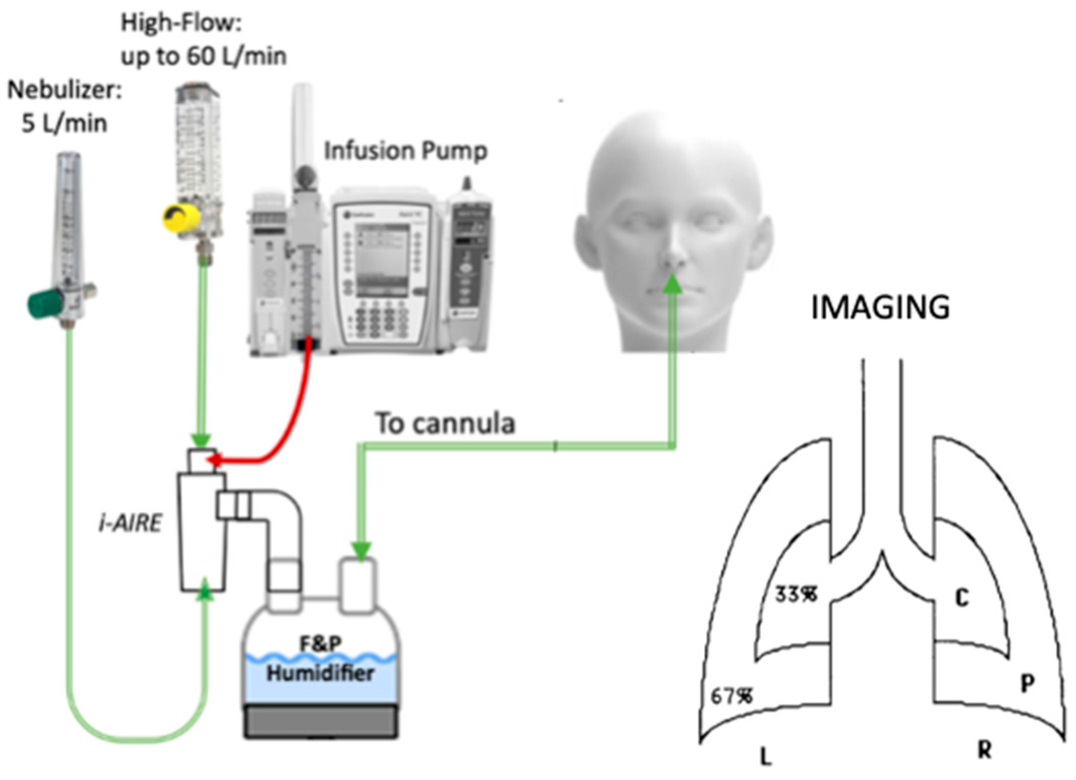 In Vivo Deposition of High-Flow Nasal Aerosols Using Breath-Enhanced ...