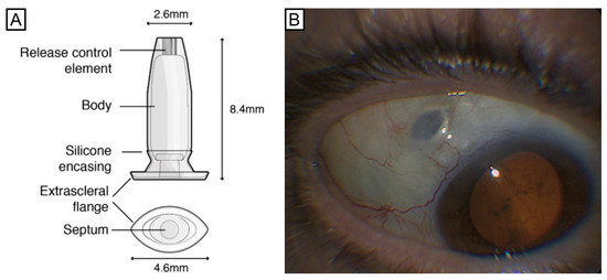 Ranibizumab Port Delivery System in Neovascular Age-Related Macular ...