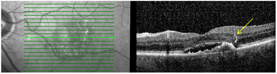 First-Year Real-Life Experience with Intravitreal Faricimab for ...