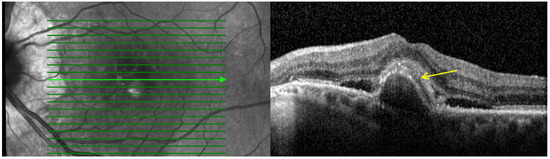 First-Year Real-Life Experience with Intravitreal Faricimab for ...