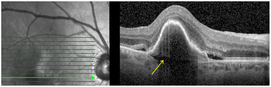 First-Year Real-Life Experience with Intravitreal Faricimab for ...