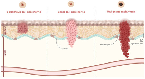 Improving Skin Cancer Treatment by Dual Drug Co-Encapsulation into ...