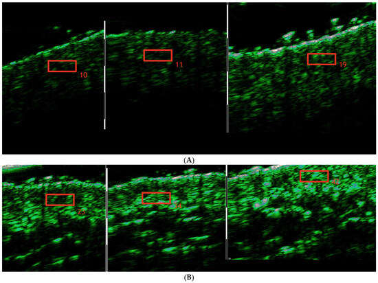 Facial Skin Density Enhancement Using Hyaluronic Acid—Based Bioactive ...