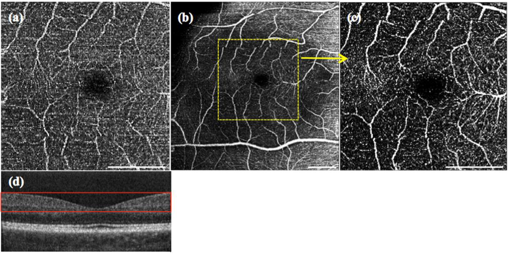 Wide-Field OCT Angiography at 400 KHz Utilizing Spectral Splitting