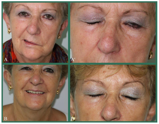 Recovery from Idiopathic Facial Paralysis (Bell’s Palsy) Using ...