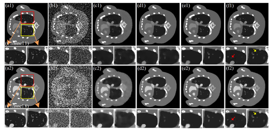 Tensor Dictionary Learning with an Enhanced Sparsity Constraint for Sparse-View Spectral CT ...