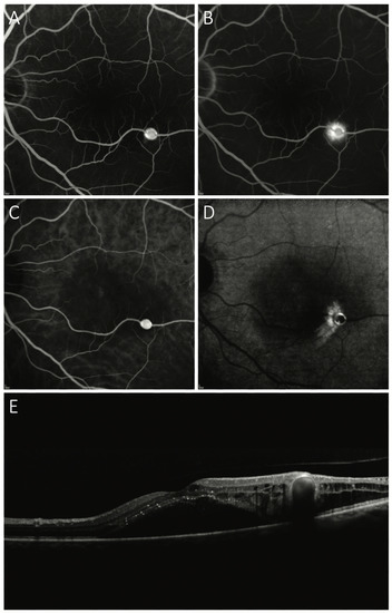Photonics | Free Full-Text | Laser Treatment for Retinal Arterial ...