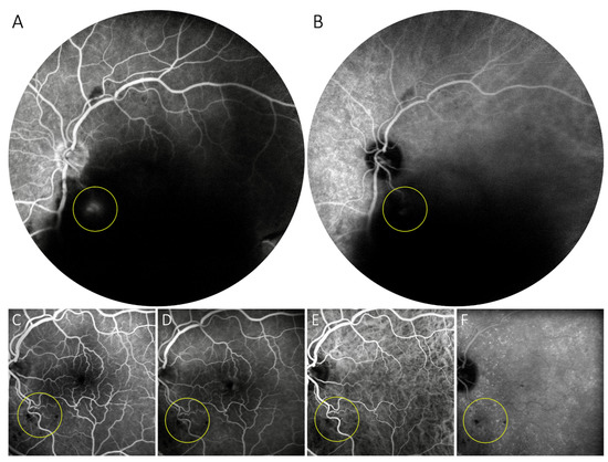 Laser Treatment for Retinal Arterial Macroaneurysm