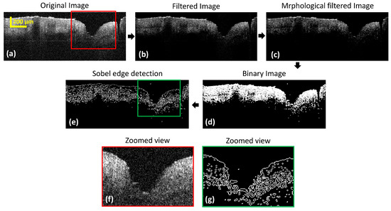A Case Report on Skin Sebum Extraction Using High Lateral Resolution ...