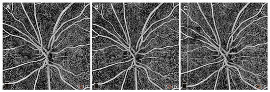 Early OCT Angiography Variations in Macular and Peripapillary Area ...