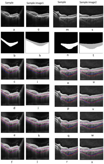 Photonics | Free Full-Text | Automatic Choroid Vascularity Index Calculation in Optical ...