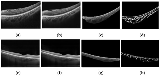 Photonics | Free Full-Text | Automatic Choroid Vascularity Index Calculation in Optical ...