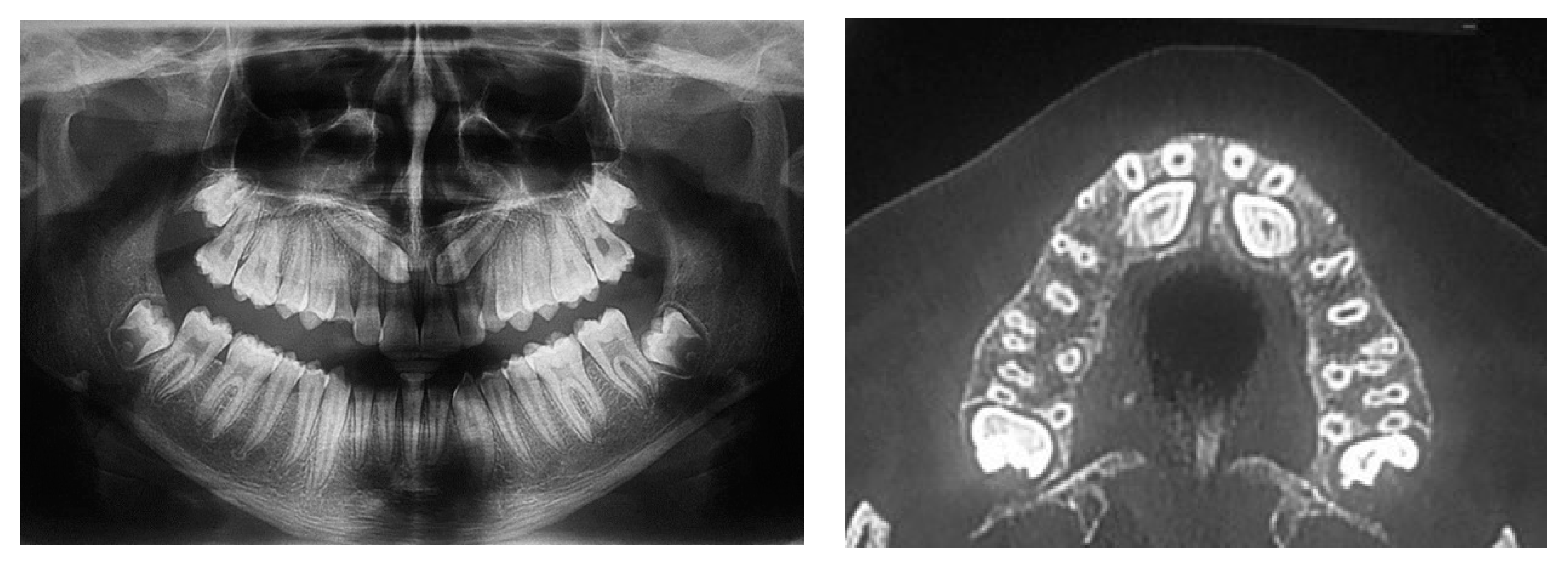 CO2 and Diode Lasers vs. Conventional Surgery in the Disinclusion of ...