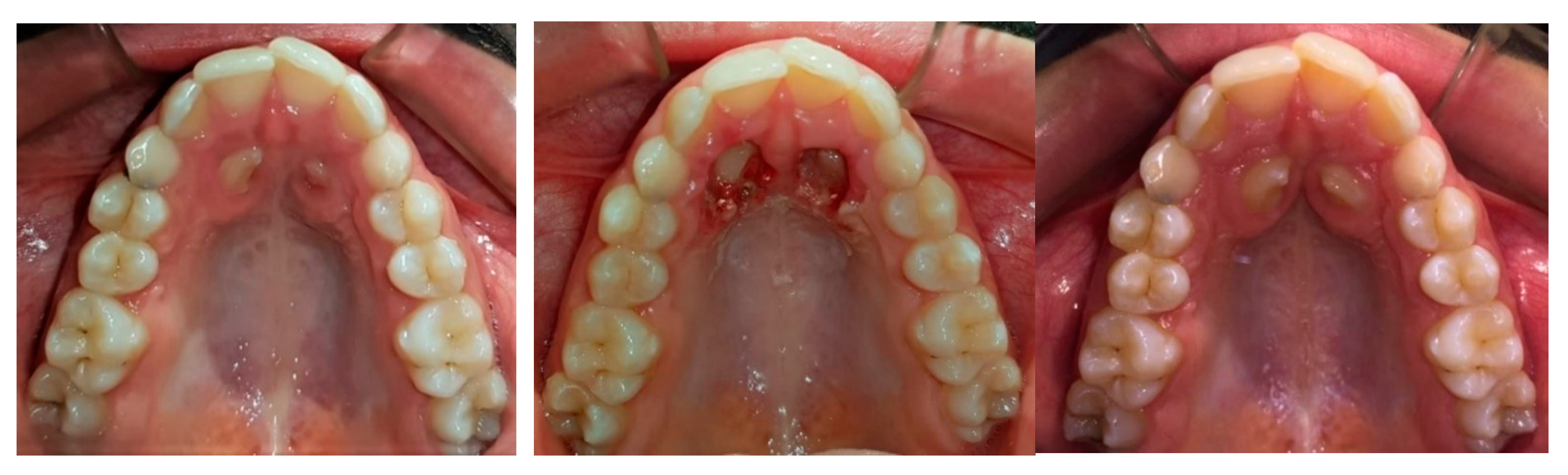 CO2 and Diode Lasers vs. Conventional Surgery in the Disinclusion of ...