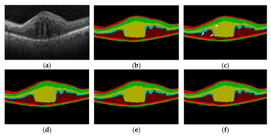 A Novel Intraretinal Layer Semantic Segmentation Method of Fundus OCT Images Based on the ...