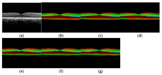A Novel Intraretinal Layer Semantic Segmentation Method of Fundus OCT Images Based on the ...