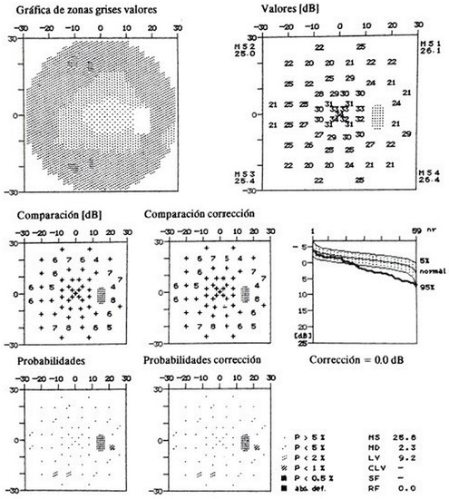 Short-Term Axial Length Changes in Myopic Eyes Induced by Defocus ...