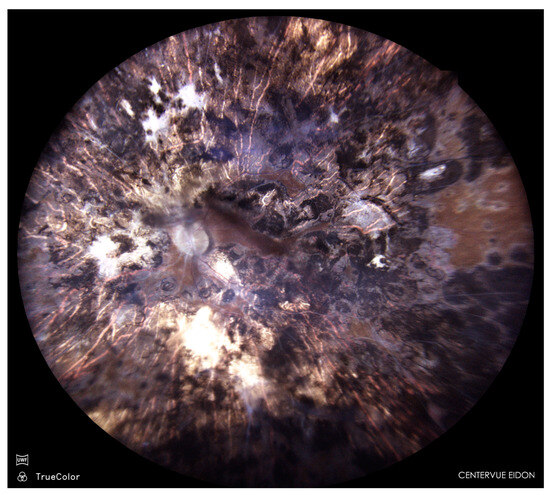 Lasers in Medicine: The Changing Role of Therapeutic Laser-Induced ...